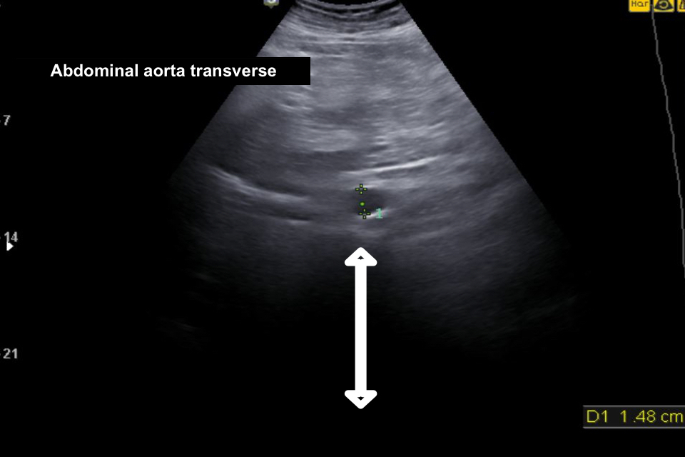 AAA screening: ultrasound image quality guidance - GOV.UK